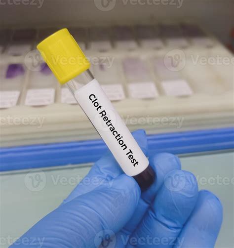 Blood Sample For Clot Retraction Test To Measures The Time Taken For A