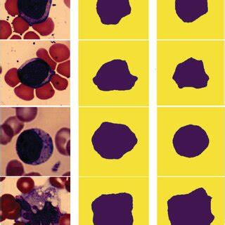 Results Of Blast Cell Segmentation Using ALL IDB2 A Microscopic