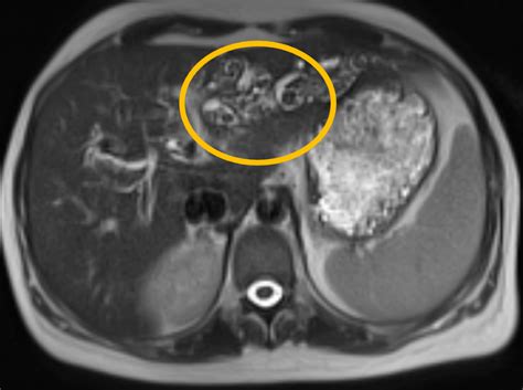 Low Phospholipid Associated Cholelithiasis Causing Post Cholecystectomy Biliary Colic Eurorad