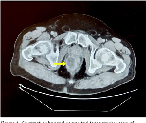 Cpt Code Incision And Drainage Abscess At Olivia Brewster Blog