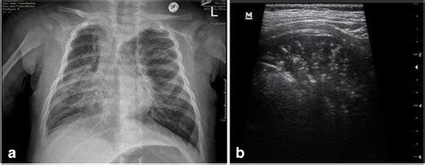 Comparison Of Cxr And Lus In A Patient With Bronchiolitis Complicated