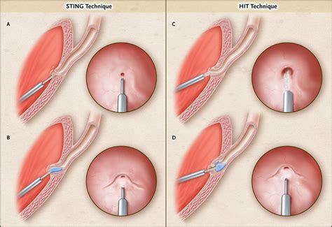 Endoscopic Treatment Of Primary Vesicoureteral Reflux New England