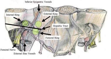 Laparoscopic Inguinal Hernia Repair Background Indications