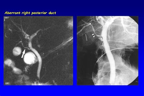 Mrcp Technique And Interpretation 10 Rules In Mrcp