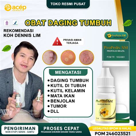 Jual Obat Kutil Penghilang Mata Ikan Kutil Kelamin Papiloma Skin Tag