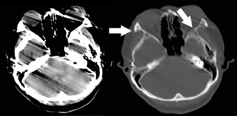 Figure 6 From Freeze Revisiting Ct Motion Artifacts Formation