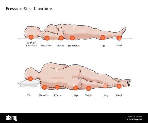 Pressure Sore Bed Cut Out Stock Images And Pictures Alamy