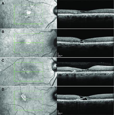 Oct Features A Demonstrates A Focal Discontinuity In The Ellipsoid Download Scientific
