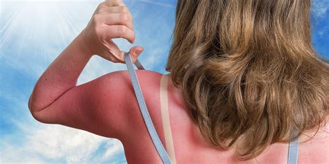 Eritema Solare Cause E Sintomi Rimedi E E Prevenzione
