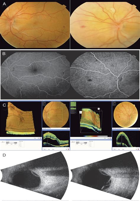 Serous Retinal Detachment As A Presenting Feature Of Chronic Retinal Cases And Brief Reports