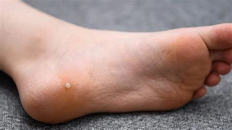 Wart Under Dermoscopy Features And Diagnosis Guide Iboolo