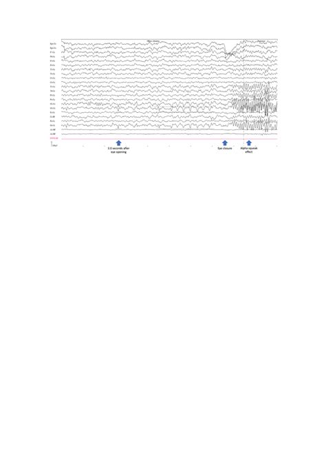 the same epoch as figure 1 in a referential montage central reference