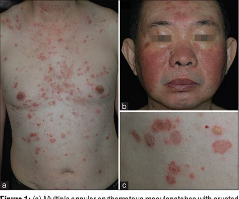 Iggiga Pemphigus Presenting With Mixed Clinical Features Of Pemphigus Erythematosus And Iga