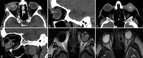 Imaging Of The Primary Visual Pathway Based On Visual Deficits Journal Of Clinical Imaging Science
