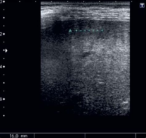 Figure 1 From Radiofrequency Ablation Guided By Contrast Enhanced