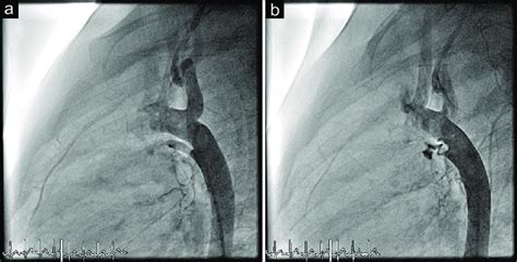 Transaortic Closure Of A Type E Patent Ductus Arteriosus A Angiogram Download Scientific
