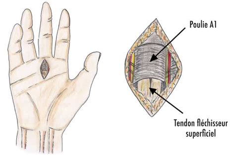 Opération Doigt à Ressaut Chirurgie Convalescence Complications Et Arrêt De Travail Pr Opération Doigt à Ressaut Chirurgie Convalescence Complications Et Arrêt De Travail Pr