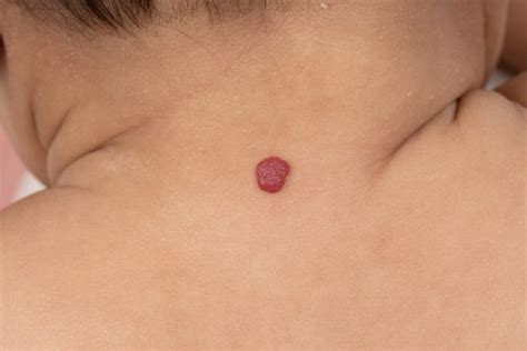 Hemangiom Smultronmärke Rikshandboken I Barnhälsovård