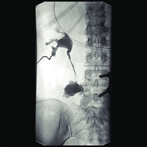 Simultaneous Antegrade Nephrostogram And Retrograde Ureterogram Reveal Download Scientific