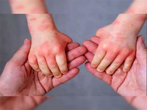 Tomato Flu Symptoms And Precautions Remedies For Tomato Flu Tomato