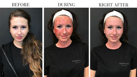 Rf Microneedling Before And After Care