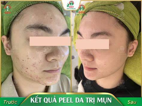 Quy Trình Chăm Sóc Da Sau Peel Nên Làm Gì Kiêng Gì Da Liễu Thẩm Mỹ Gsv