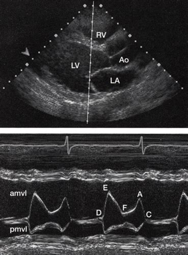 Doppler Echo Waveforms And Myocardial Segments Exam 1 Flashcards