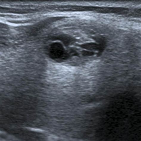 Ti Rads 4b Nódulo Con Dos Criterios Sospechosos De Malignidad Download Scientific Diagram