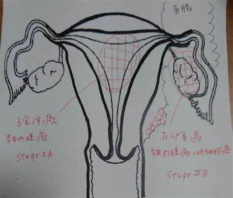 卵巣癌にも罹患してました 腹痛からの子宮体癌・卵巣癌｡﹏