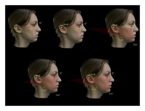 vertical angular measurements for 3d facial soft tissue r right part