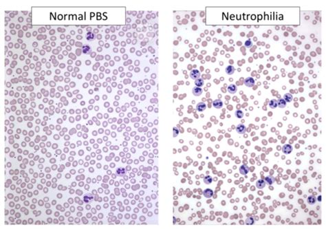 Xerocytosis Explained