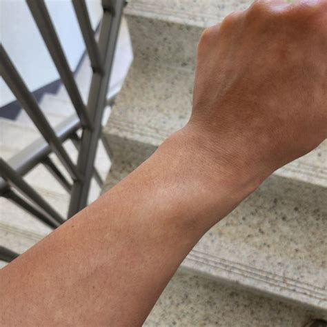 피부 하얀 반점 지식in