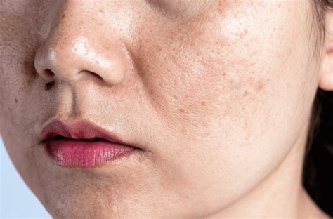 Sun Damaged Skin Steele Dermatology Atlanta Alpharetta Georgia