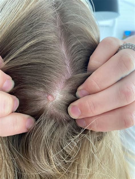 Mole On Scalp Rskincancer