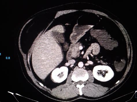 Intermuscular Abdominal Wall Lipoma Artofit