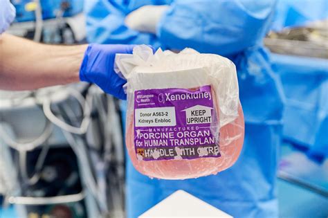 A Woman In The Us Is The Third Person To Receive A Gene Edited Pig