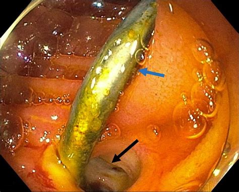 Endoscopic Retrograde Cholangiopancreatography Showing Migrated