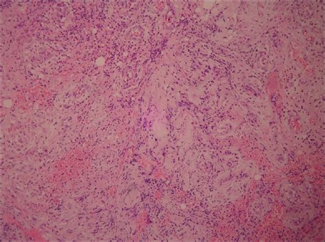 Genital Pyoderma Gangrenosum Pmc