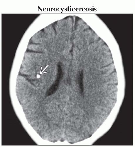 Solitary Parenchymal Calcification Neupsy Key
