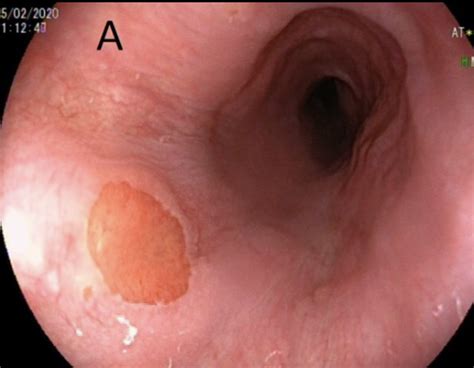 Esophageal Inlet Patch Endoscopic Prevalence In Full Sedated Patients