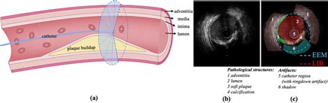 A Illustration Of The Intravascular Ultrasound Ivus Imaging Ivus