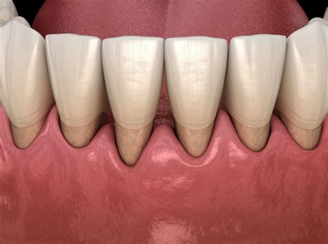 Treatments For The Black Triangle Cromwell Dentists Fedorciw