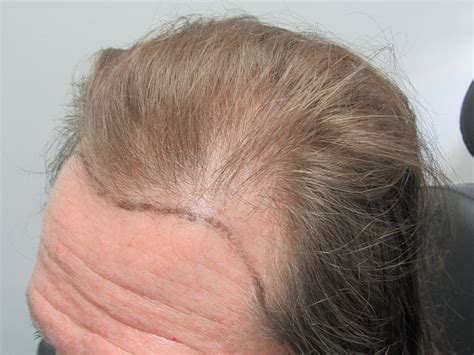 Patient 368571 Transgender Hair Transplant Before And After Photos Dr