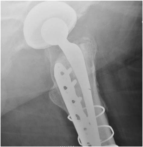 Lateral Radiograph Of The Hip Showing A Stem Fracture Of A Short Exeter Download Scientific