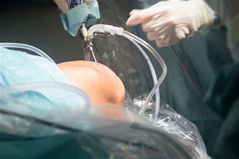 무릎 열쇠 구멍 수술 병원 관절 수술 의료 절차 극장을 운영 하는 응급실에서 건강관리와 의술에 대한 스톡 사진 및 기타 이미지