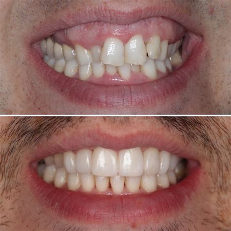 Dents Qui Se Chevauchent Causes Traitement Et Risques