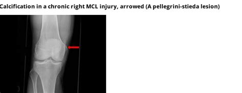 Complex Ligament Injuries Mcl Pcl Surgeons And Consultants Yorkshire