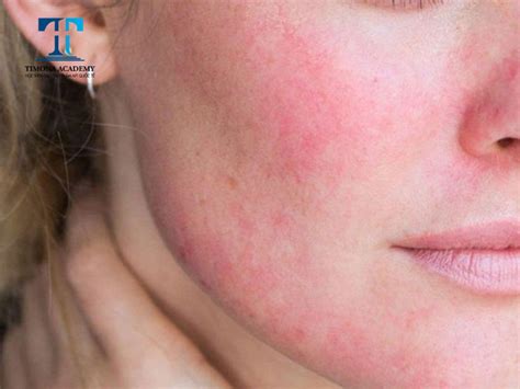 Da Nhiễm Corticoid Là Gì Biểu Hiện Và Cách điều Trị