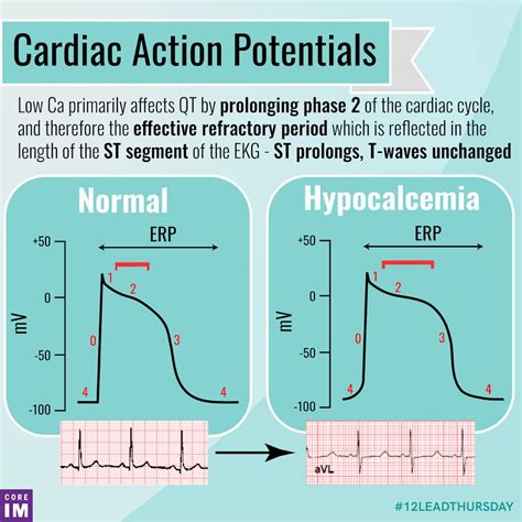 1 Goood Morning Medtwitter Its 12leadthursday And You Know What That Means Remember To