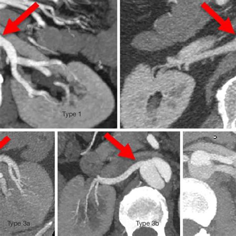 Illustrative Examples Of Different Types Of Renal Artery Involvement Download Scientific